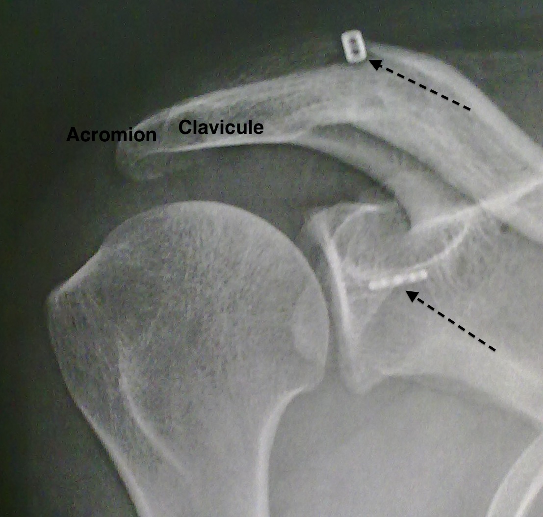 Acromio-claviculaire - Dr Charles Bessiere - Epaule Var